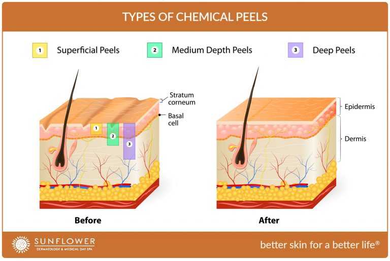 Chemical Peels to Rejuvenate, Smooth and Tone Your Skin Kansas City ...