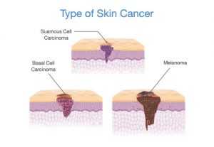 Skin Cancer - Prevention, Diagnosis and Treatment - Epiphany Dermatology