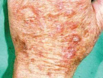 Actinic Keratosis Treatment - Epiphany Dermatology